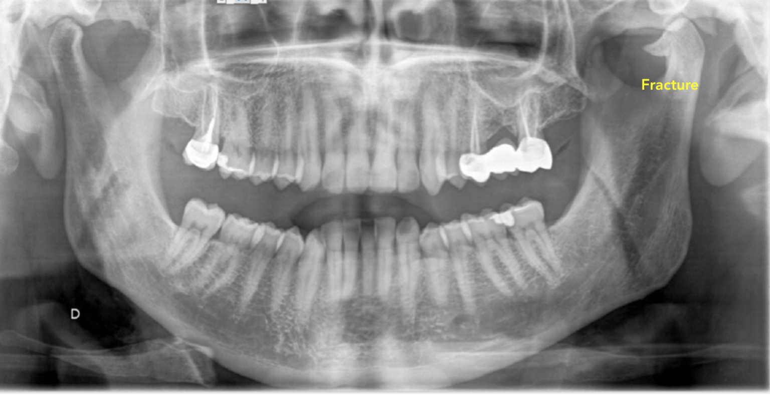 Lire Plus: Exemple de radiographies - ATM Guide Douleurs et/ou blocages ...