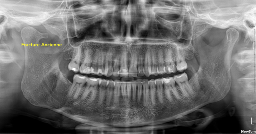 Lire Plus: Exemple de radiographies - ATM Guide Douleurs et/ou blocages ...