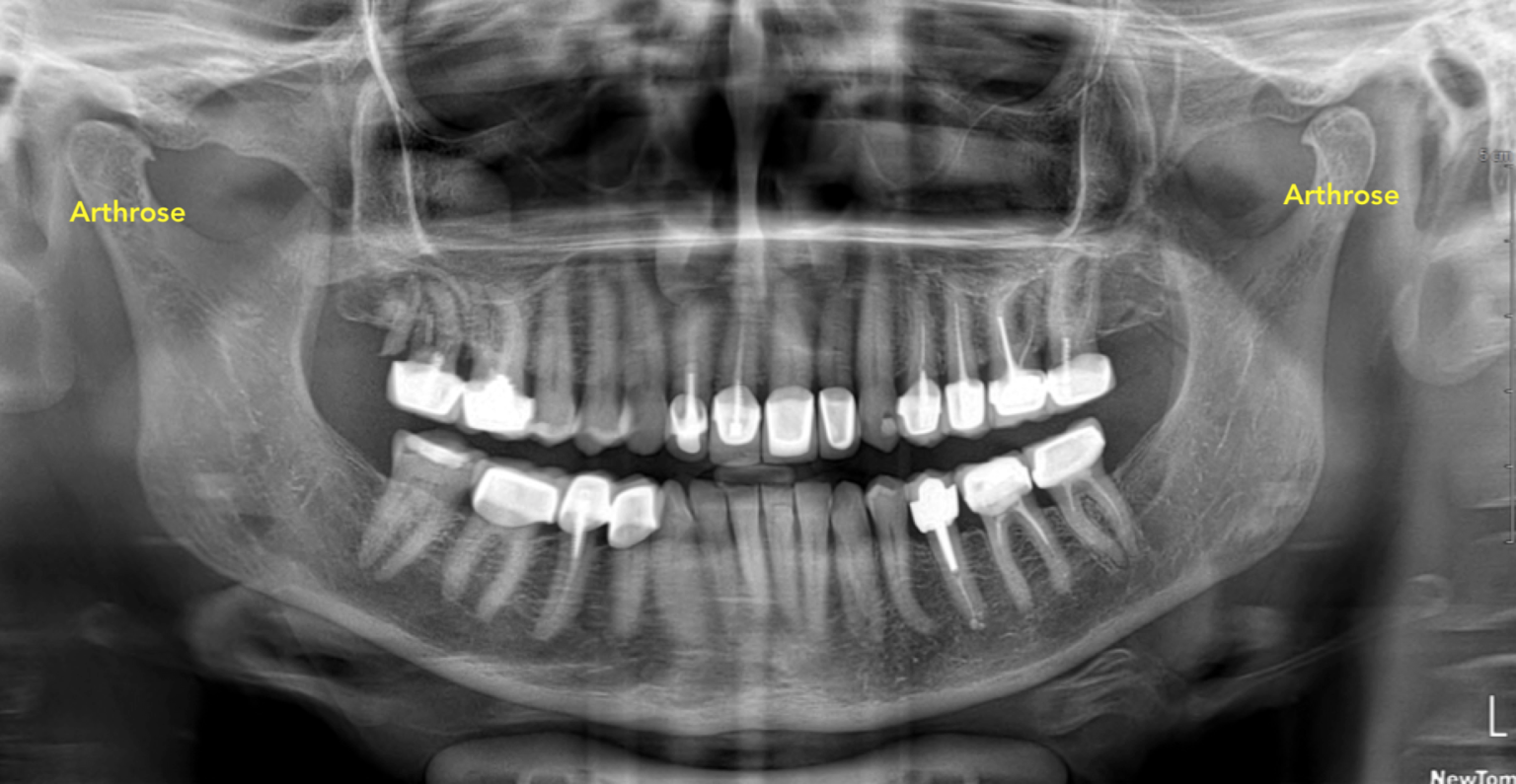 Lire Plus: Exemple de radiographies - ATM Guide Douleurs et/ou blocages ...