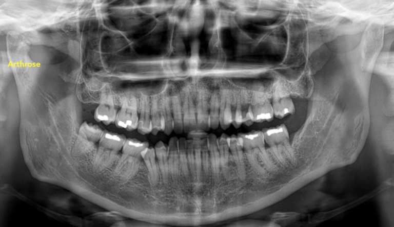 Lire Plus: Exemple de radiographies - ATM Guide Douleurs et/ou blocages ...